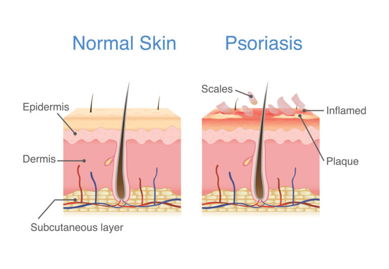 Psoriasis - Mindera Health